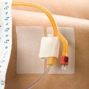 MC Johnson Cath Secure Dual Tab Device | SD Homecare